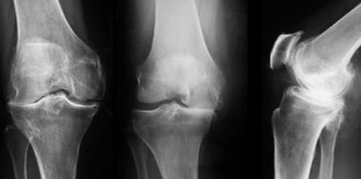 Gonartroza – ce este și cum o TRATĂM