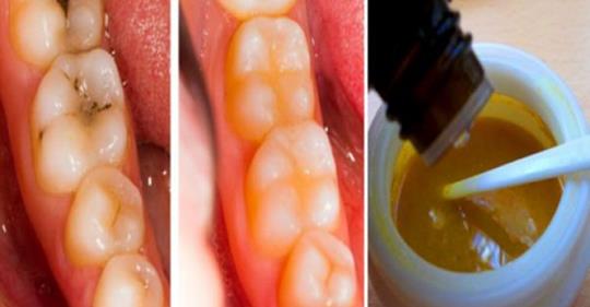 Ai carii? Soluţia naturală care te scapă de ele