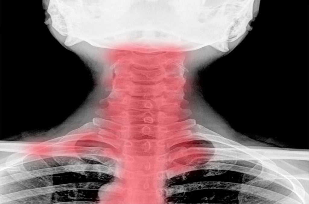 Spondiloza cervicala: cauza ametelilor si a furnicaturilor in brate