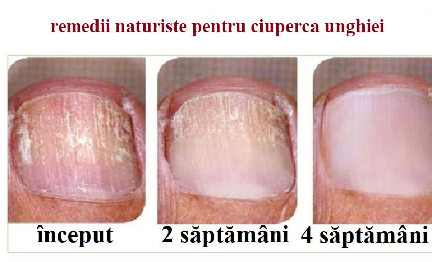 Tratamente naturiste pentru ciuperca unghiei