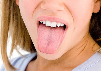 Candidoza bucală - simptomatologie si tratament