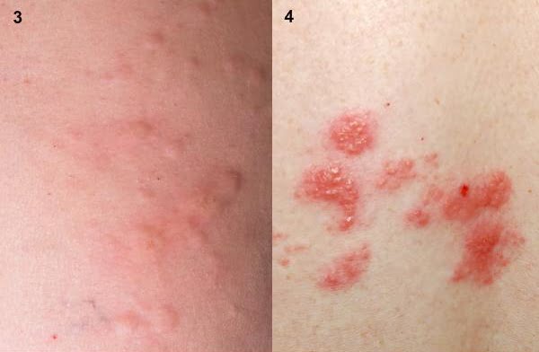 Boli de piele. Cum le recunoști pe cele mai importante