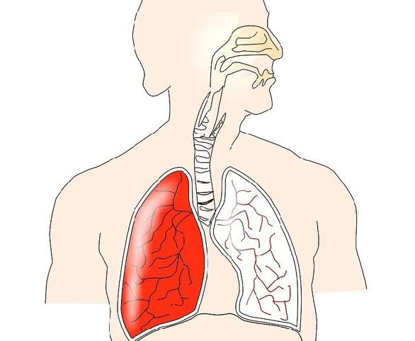 Simptomele înșelătoare ale cancerului la plămâni