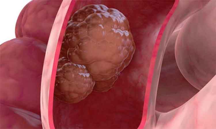 6 simptome ale CANCERULUI DE COLON pe care nimeni nu le baga in seama